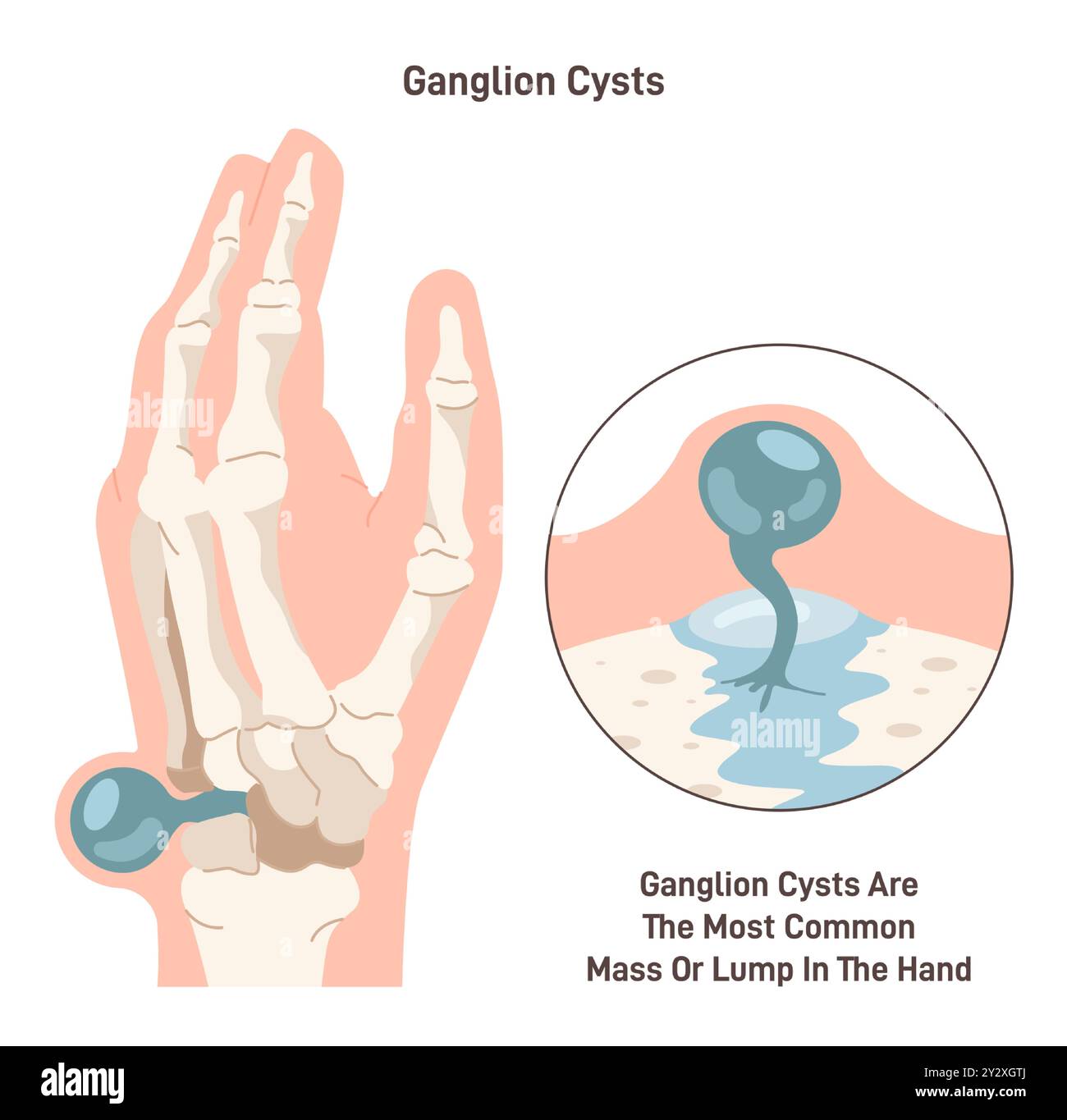 Ganglion cyst. Fluid-filled lump under the skin of a wrist or hand ...