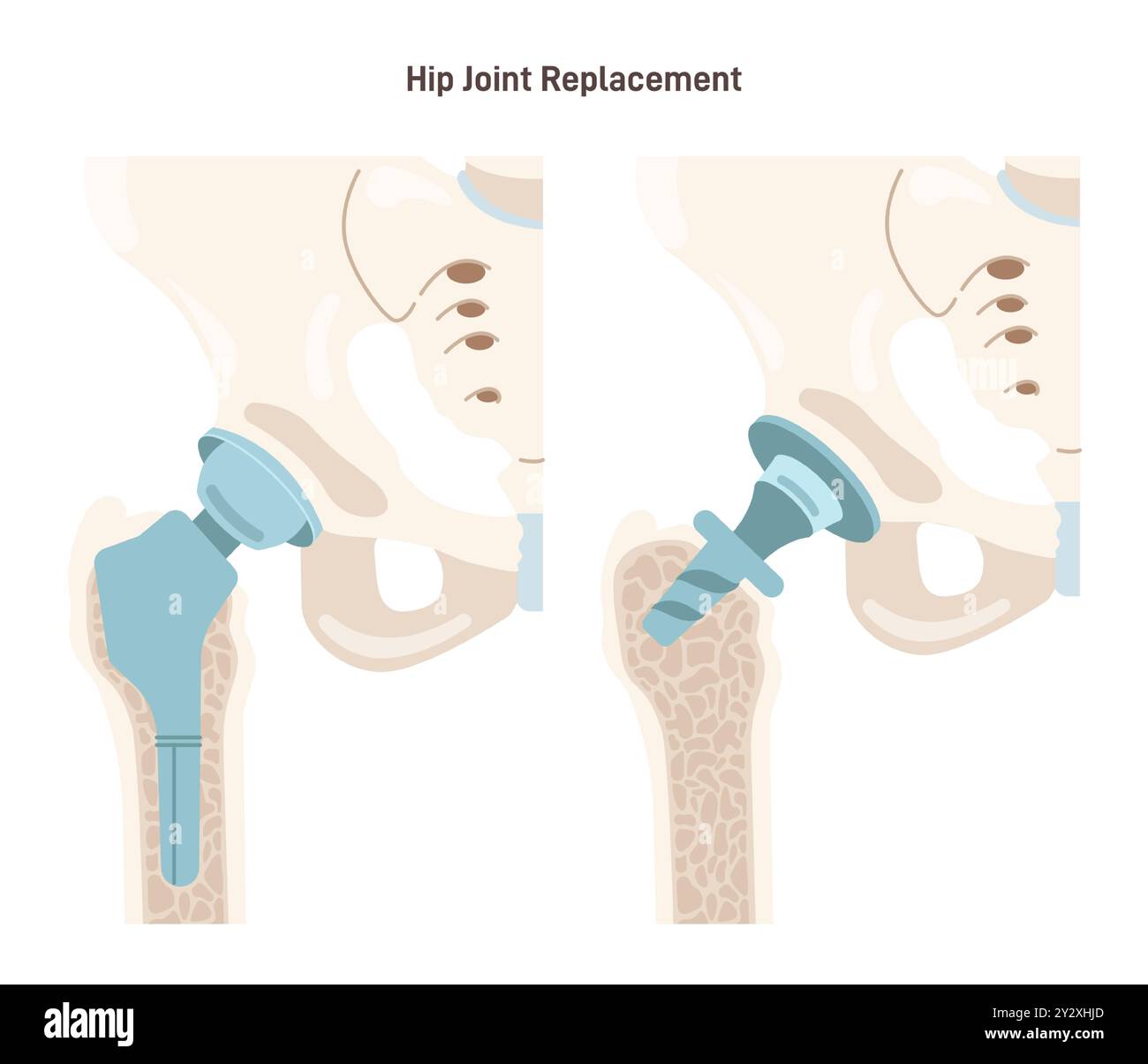 Total hip replacement hi-res stock photography and images - Alamy