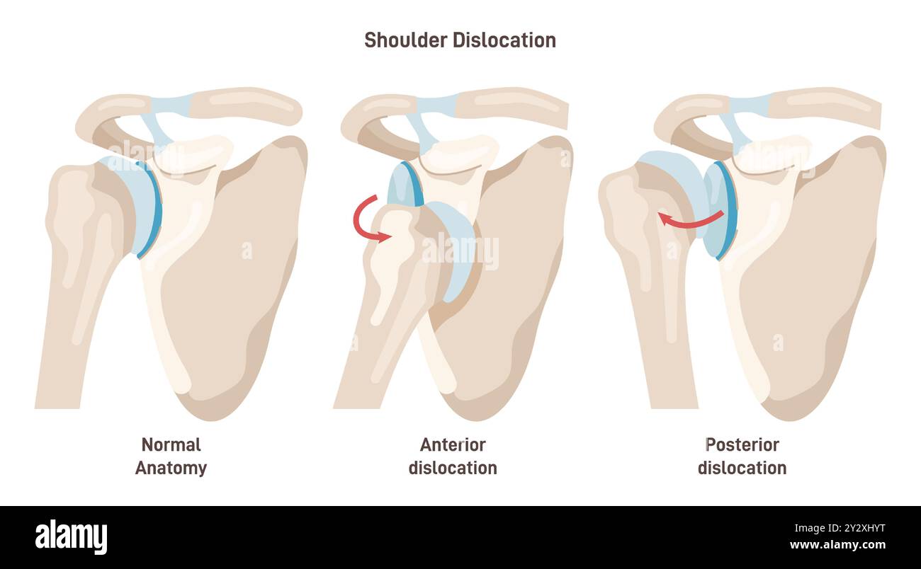 Shoulder dislocation types. Arm injury, upper arm bone pops out of the cup-shaped socket of ...