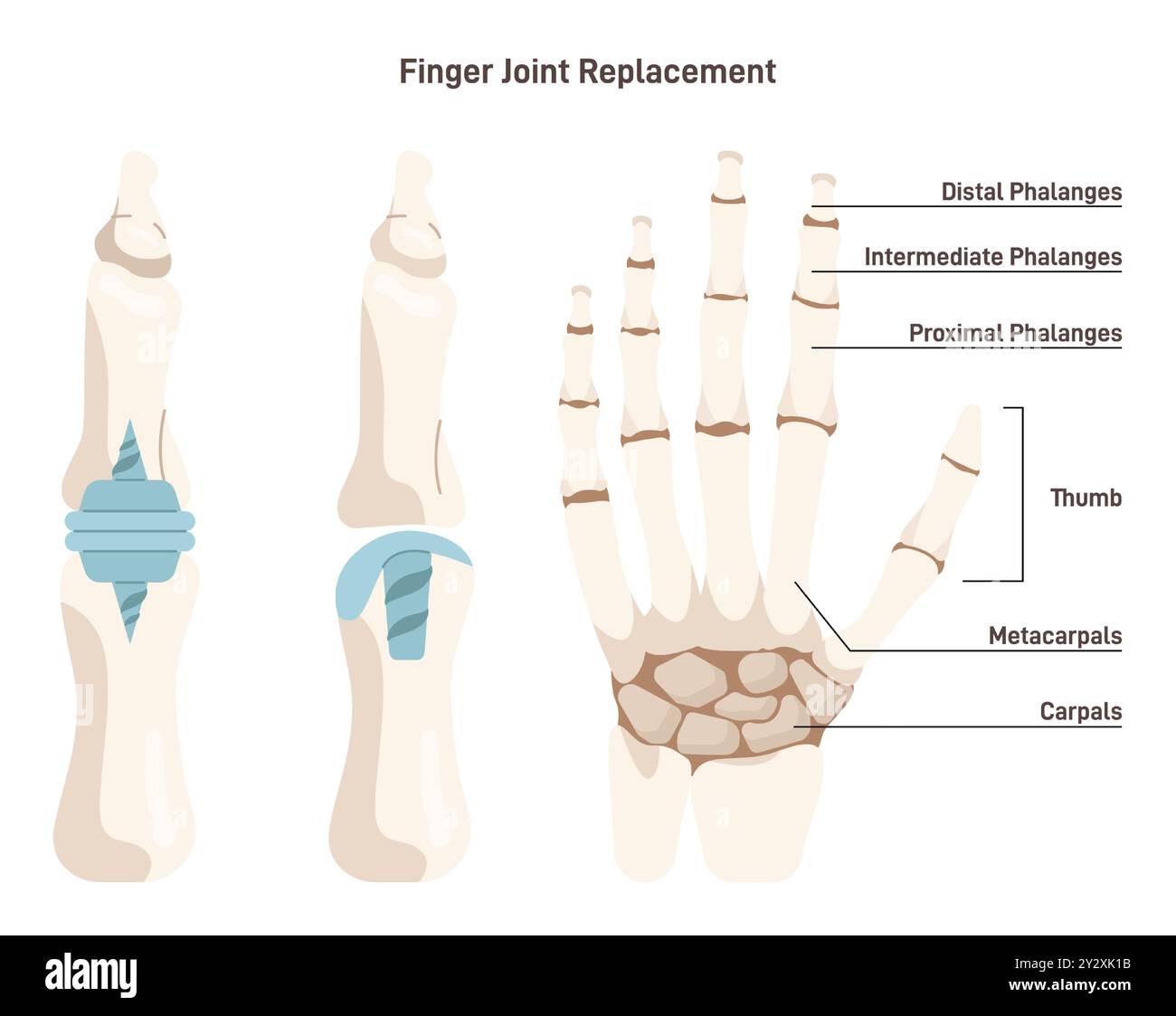 Joint implantation. Injured or distracted human joint replaced with ...