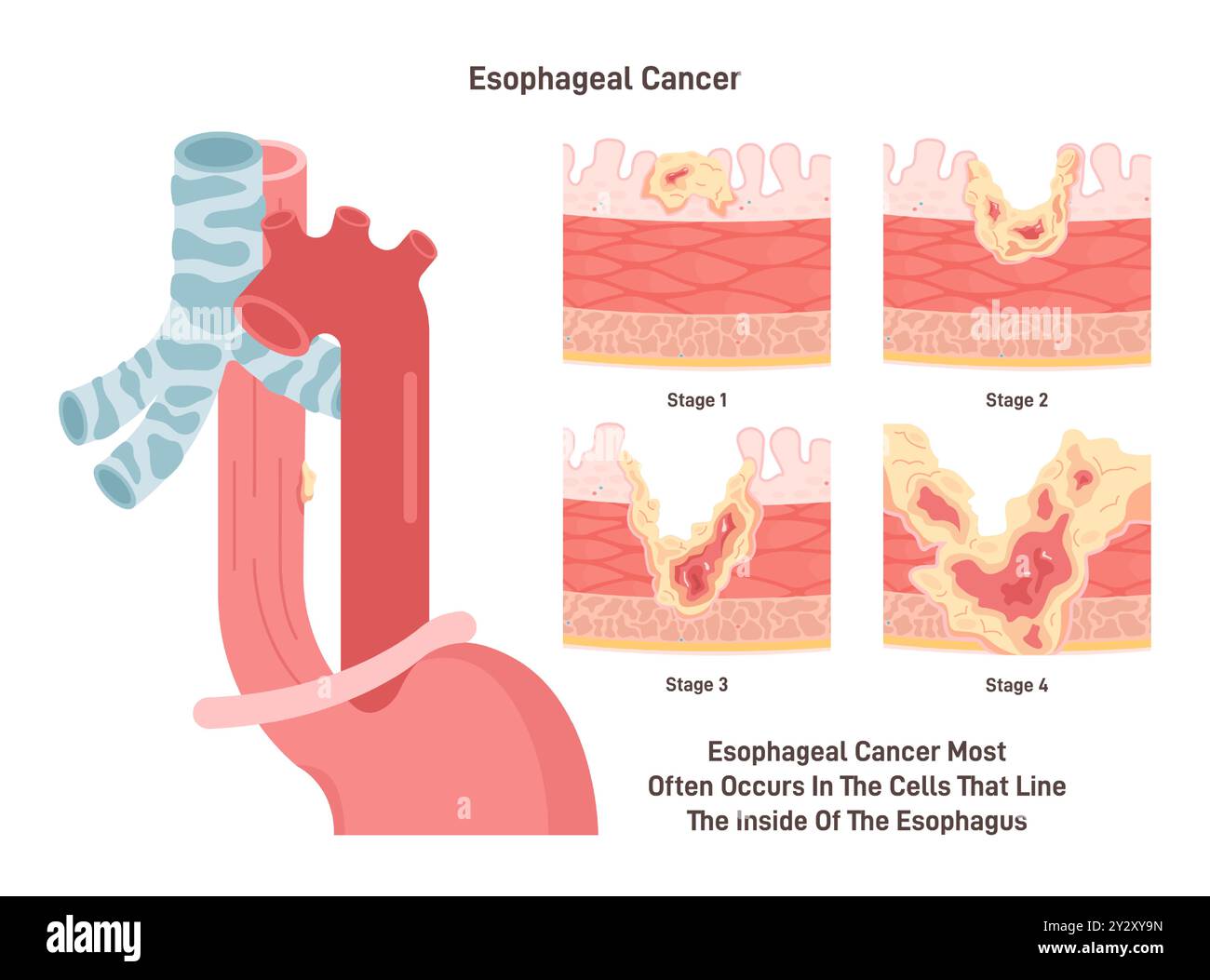 Esophageal cancer. Malignant inflammation of esophagus wall cells ...