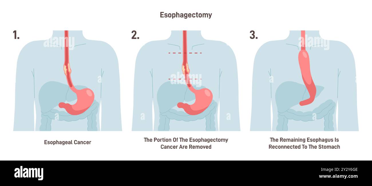 Esophageal stricture Stock Vector Images - Alamy