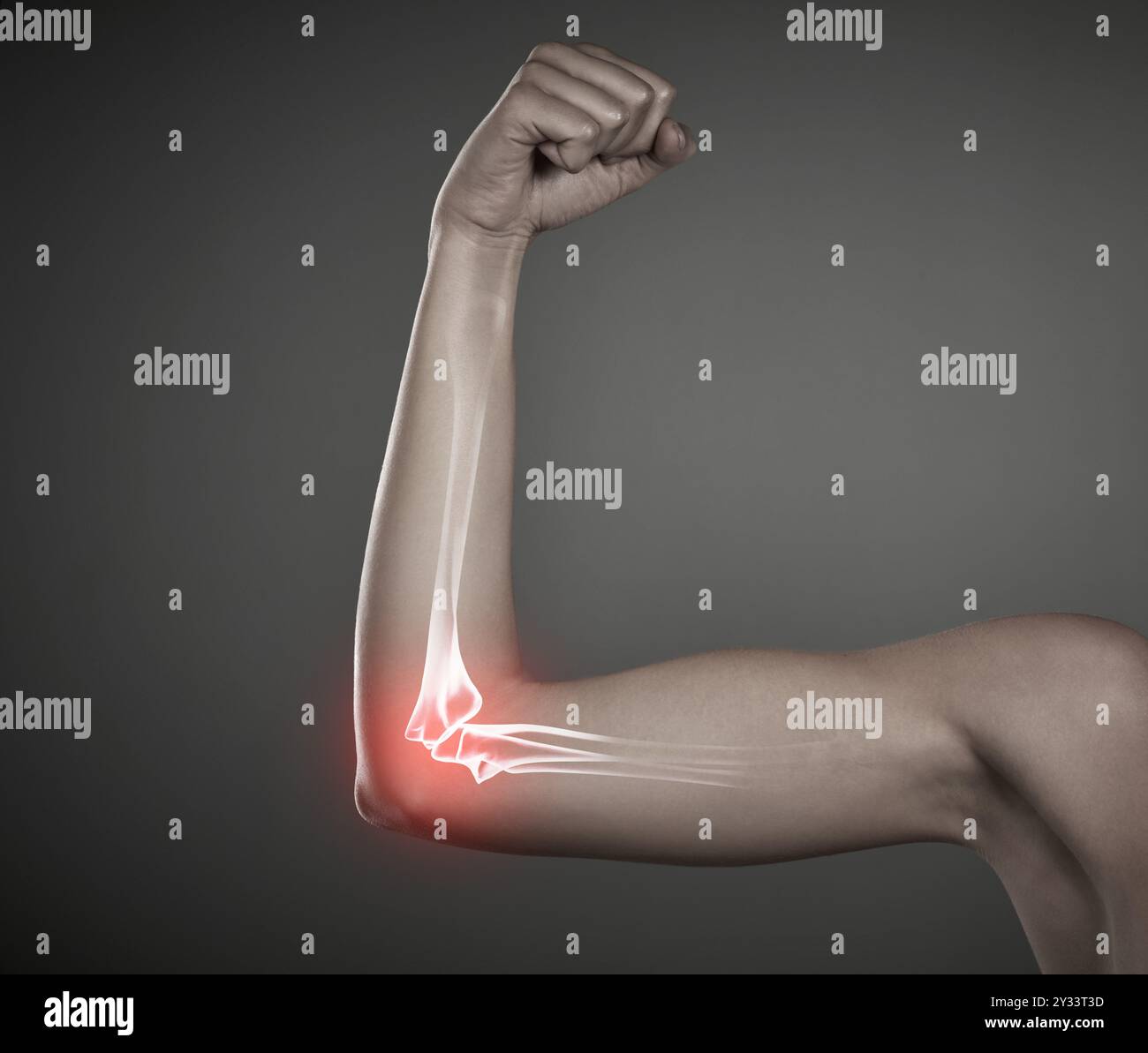 Woman, arm pain and x ray of injury in studio, training accident and ...