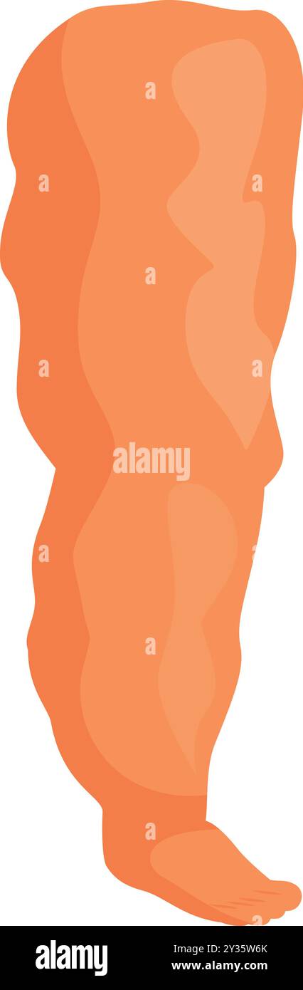 Human leg with advanced elephantiasis, a tropical disease causing ...