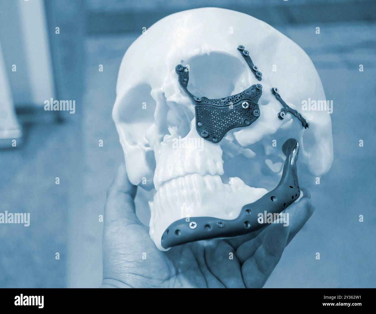 Man holding in hand proto-human skull from white plastic with titanium implants in form of ...