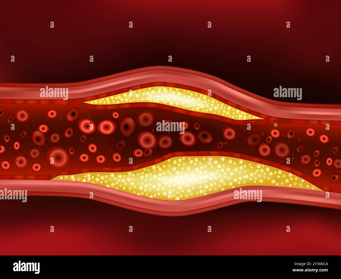 Cholesterol plaque in artery. Atherosclerosis Stock Vector Image & Art ...