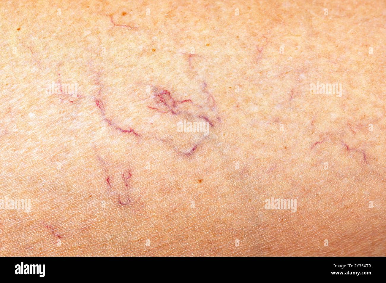Vascular network of capillaries on the female leg close up Stock Photo ...