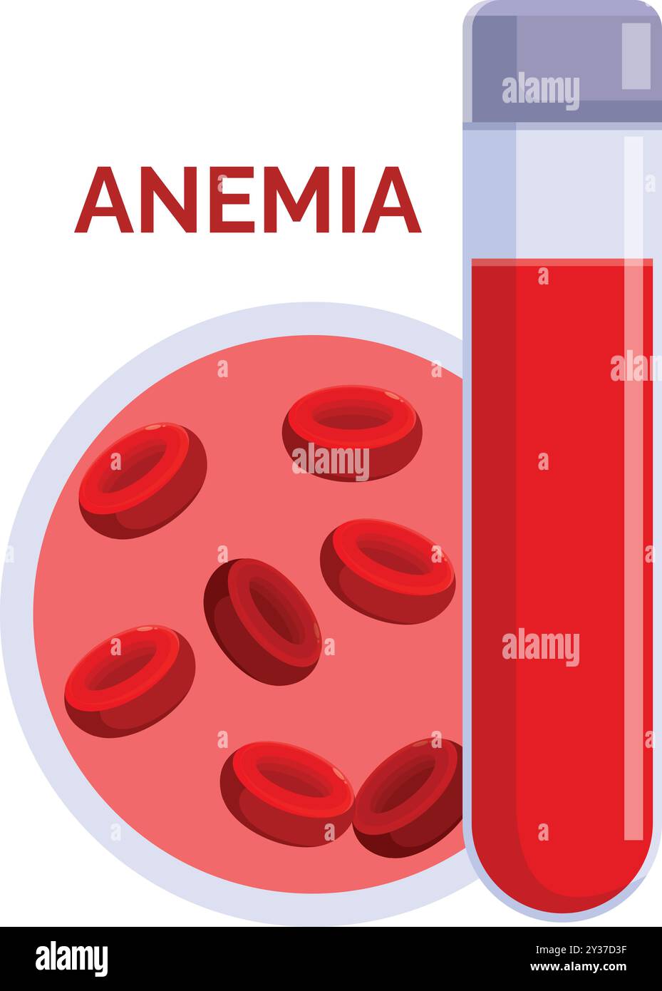 Medical illustration showing a blood test with a low red blood cell ...