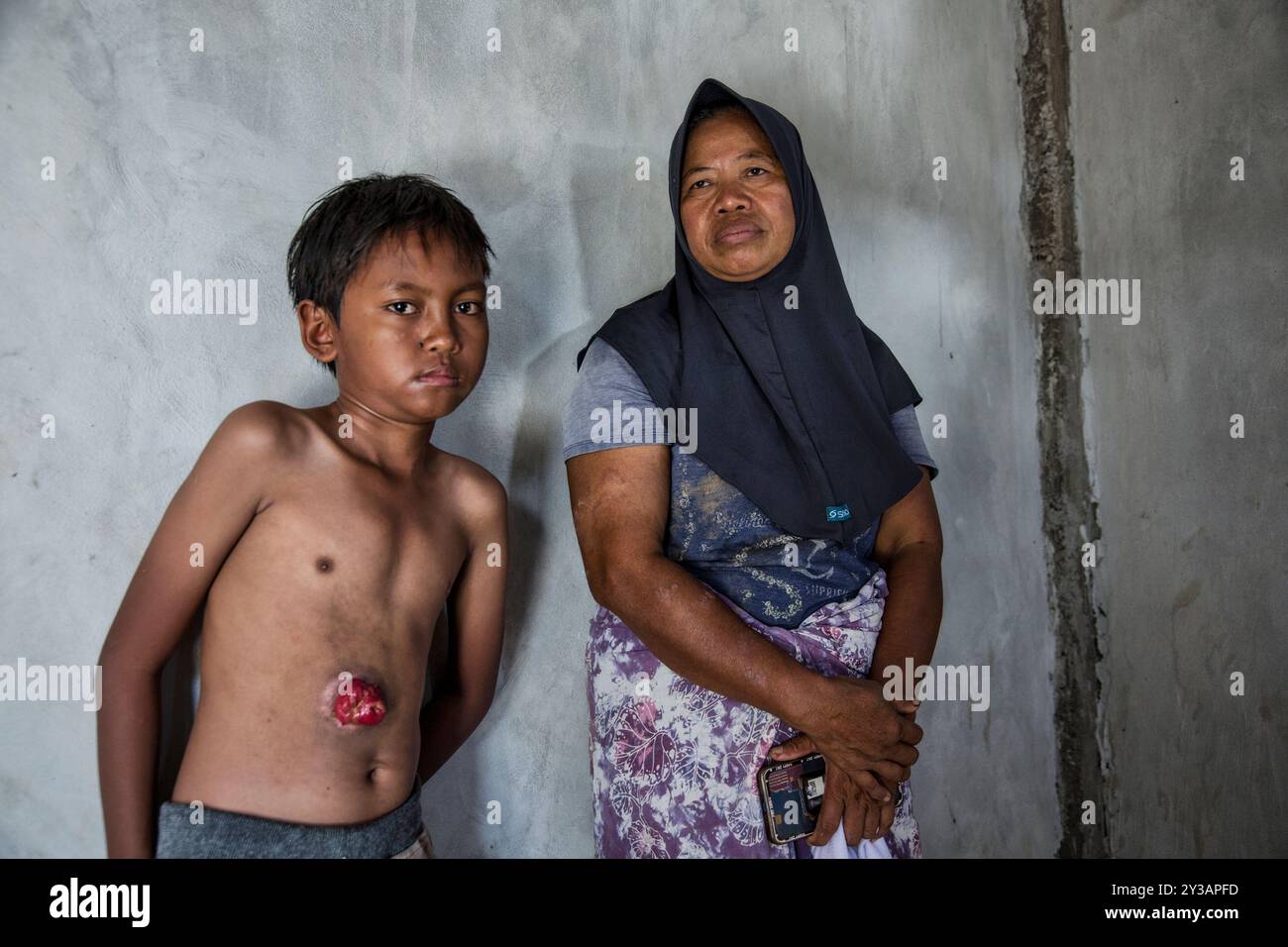 Mercury poisoning, illegal gold mining effects, Lombok, Indonesia, Asia ...