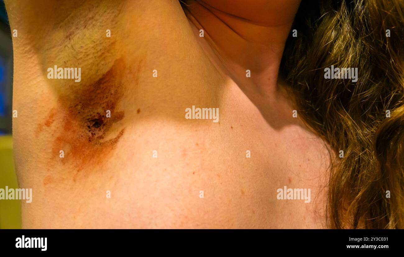 birthmark removal surgery complication, infected wound under the armpit ...