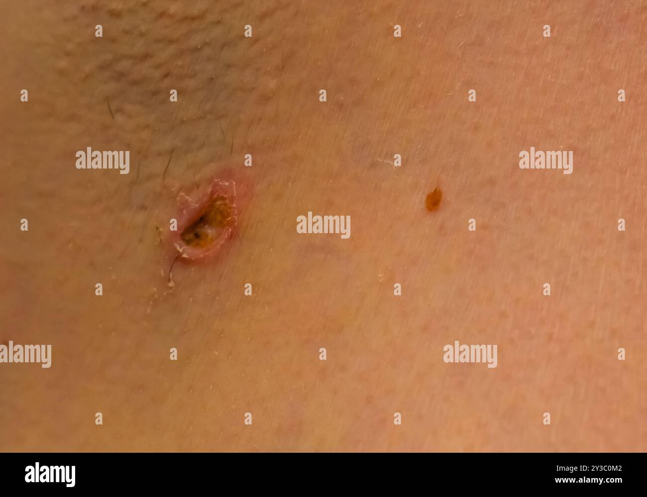 infected wound closeup, complication after birthmark removal surgery ...