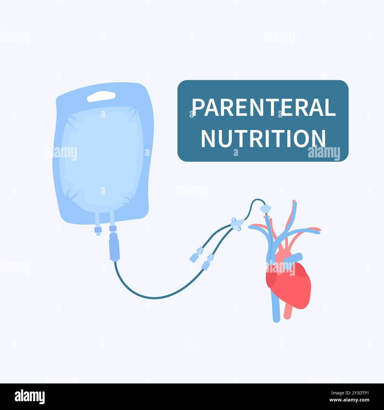 Parenteral nutrition bag system for intravenous feeding therapy Stock ...