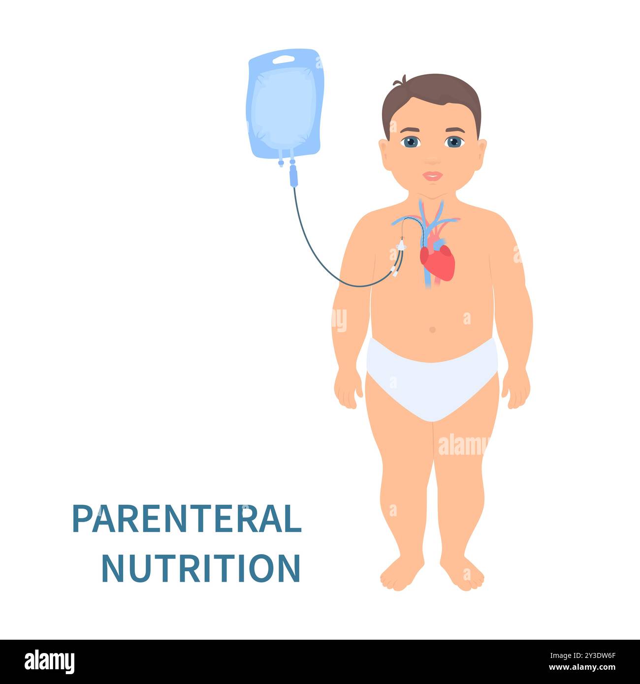 Child receiving parenteral nutrition through a central intravenous ...