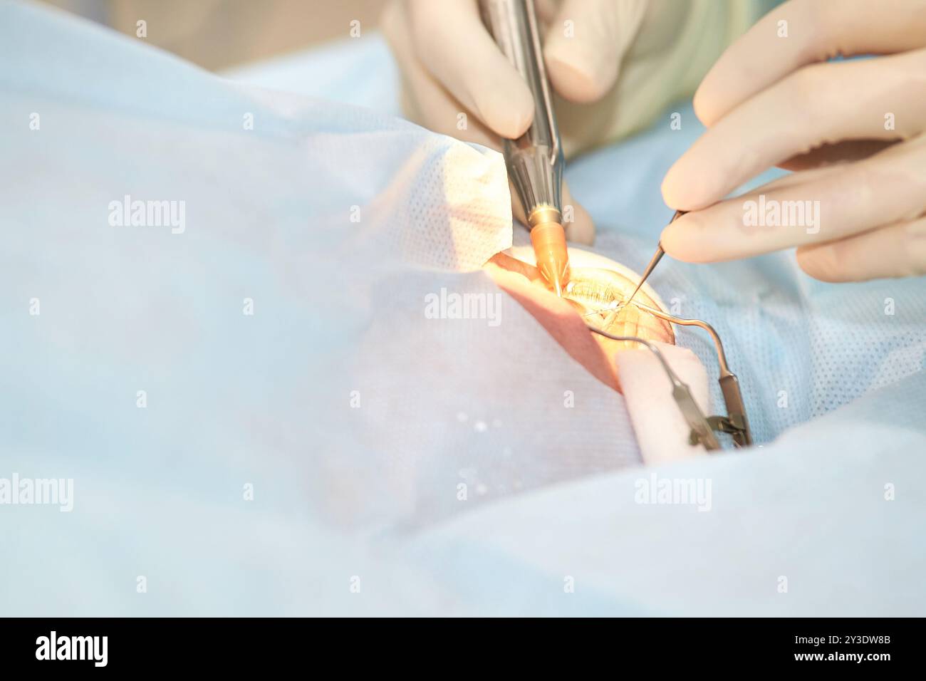 Precise eye surgery procedure in hospital operating room with advanced ...