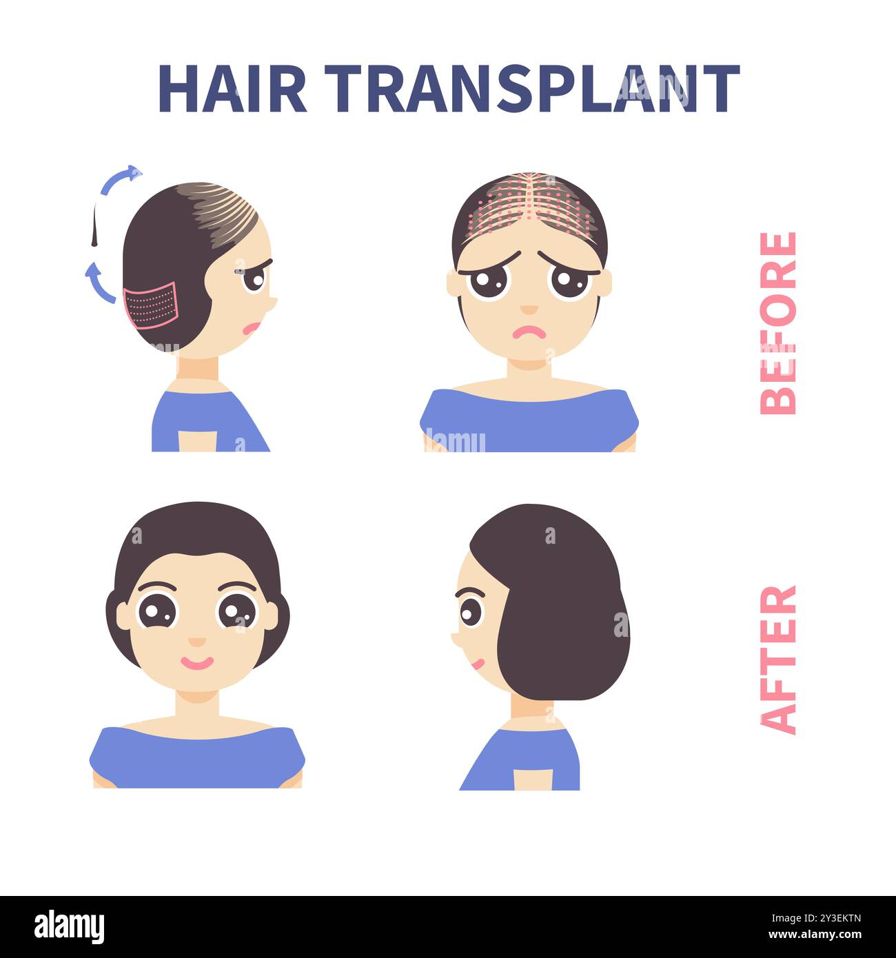 FUE hair transplant treatment of alopecia illustration Stock Vector ...