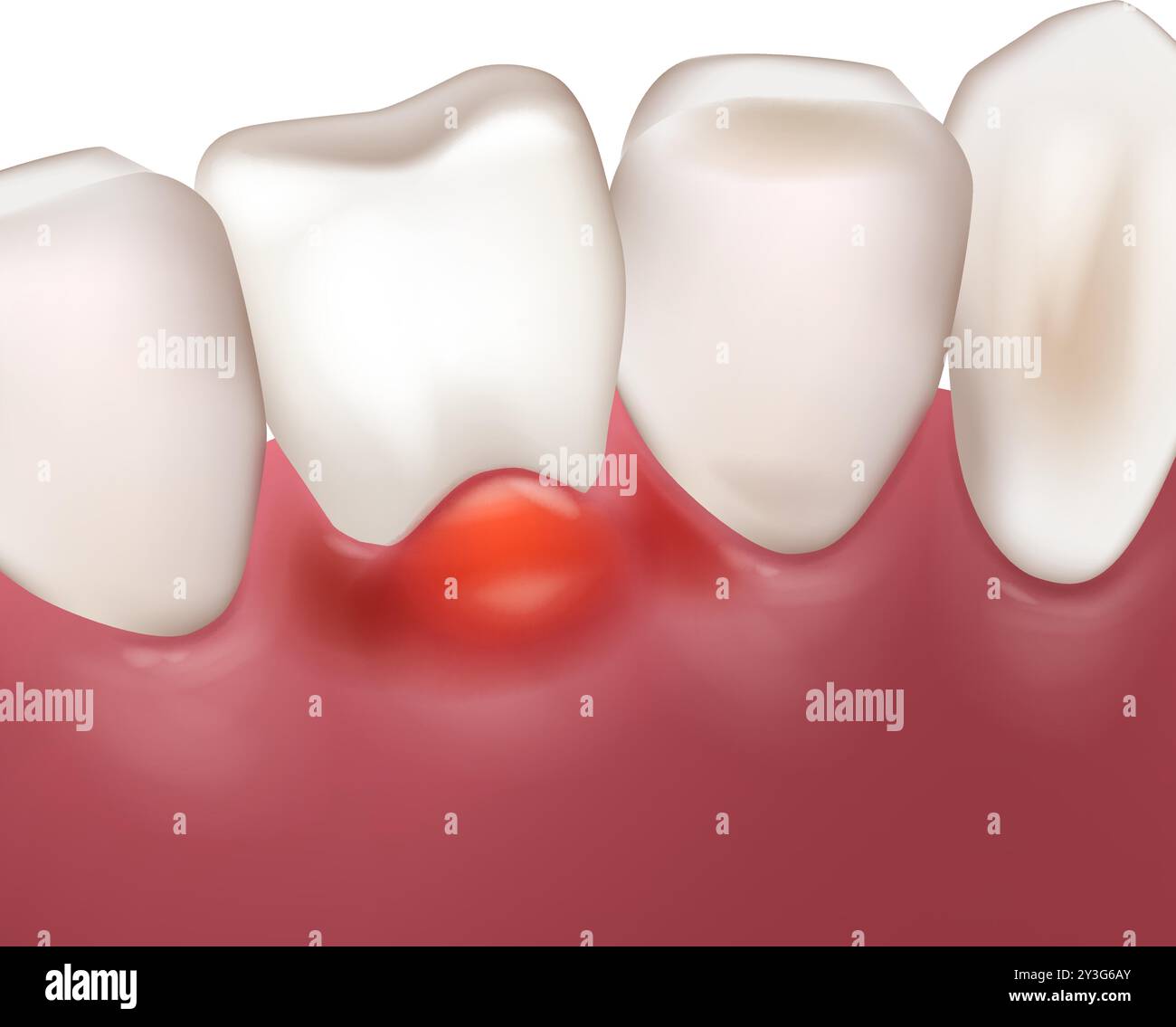 Oral gingivitis. Gum disease or gum inflammation from gingivitis ...