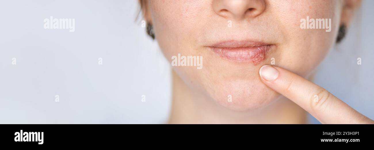 Skin care and lip health awareness with close up focus on cold sore and ...