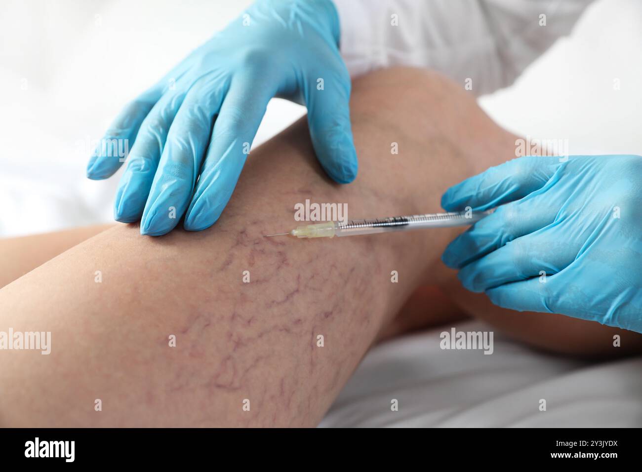 Varicose veins treatment. Doctor giving injection to patient indoors ...