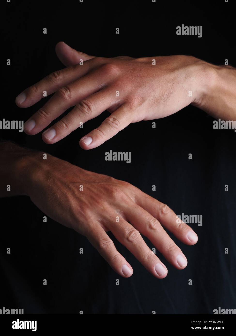 Comparison of two male hands one is swollen Stock Photo - Alamy