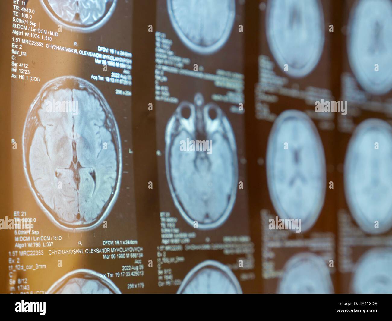 MRI of the human brain of a patient with multiple sclerosis of the ...