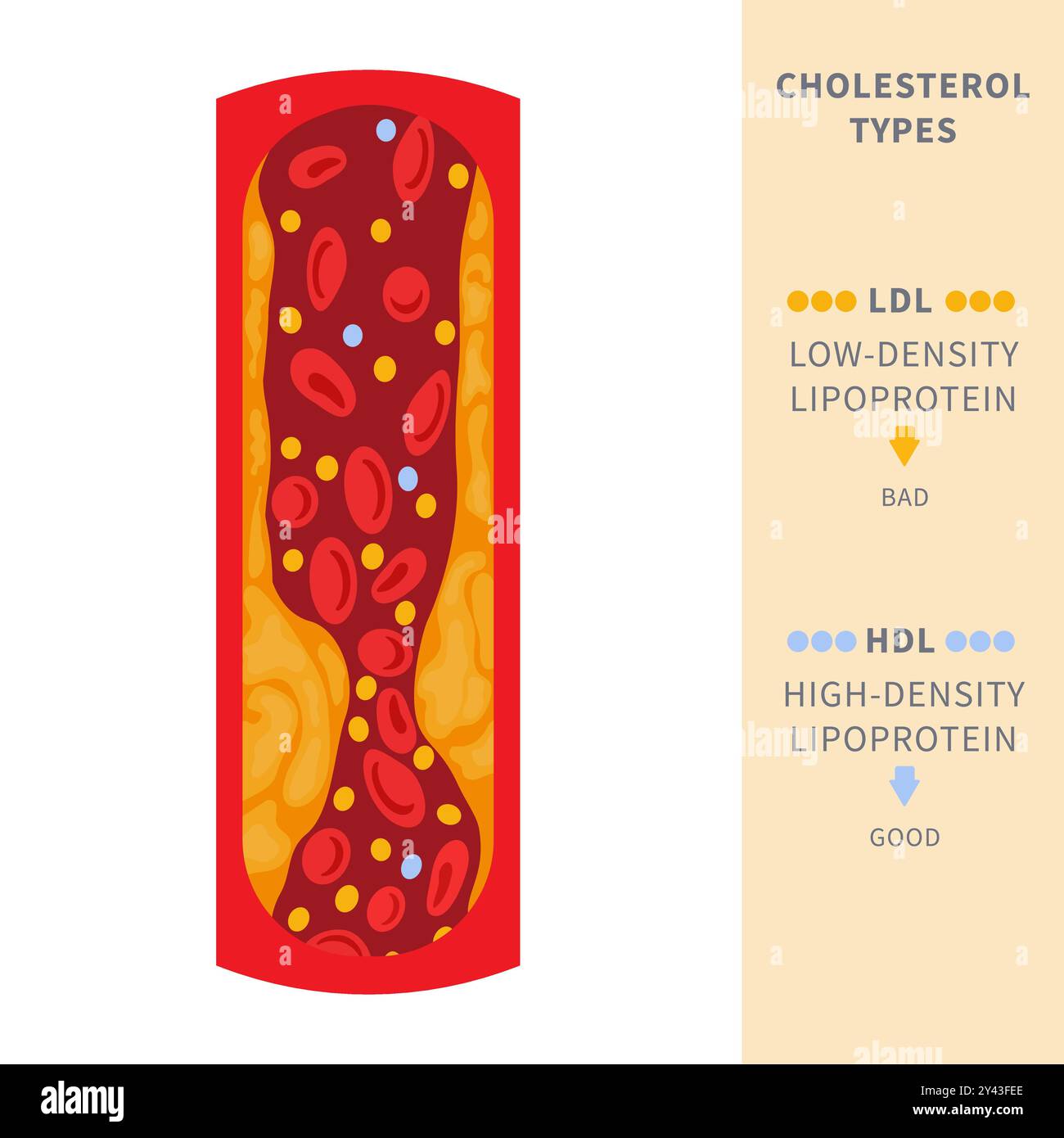 Cholesterol plaque buildup in blocked artery diagram Stock Vector Image ...