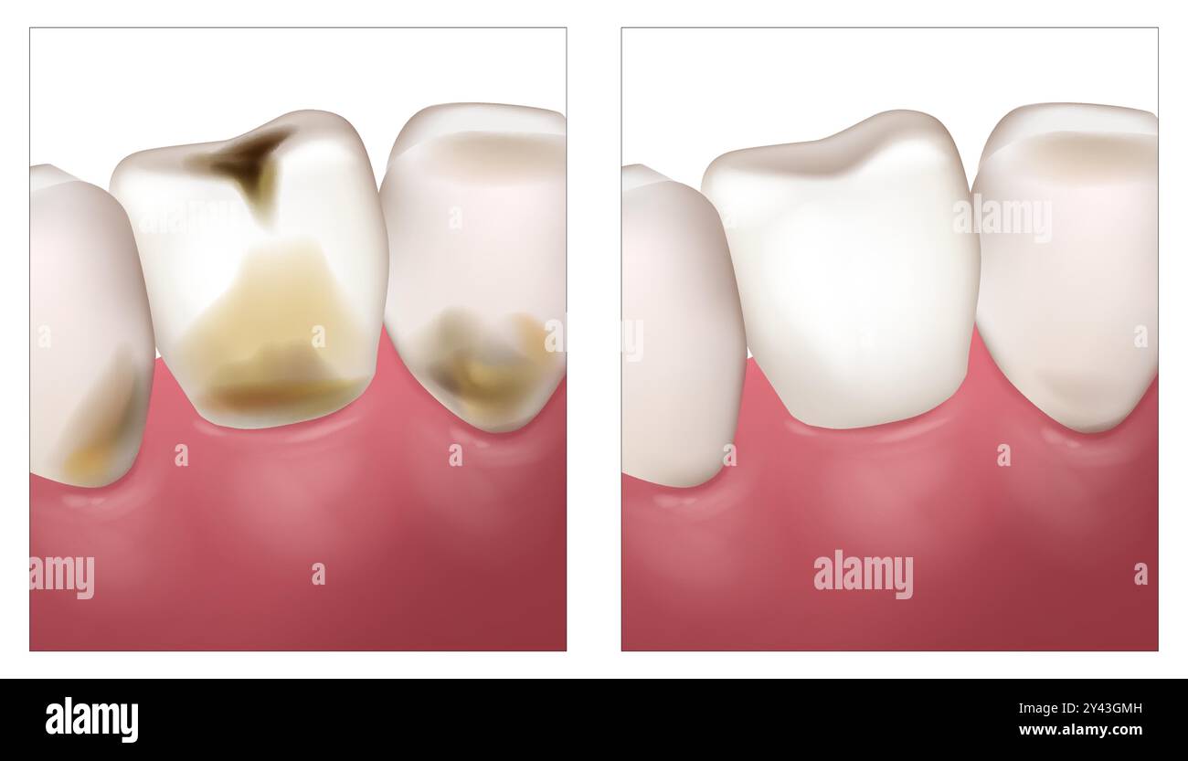 Dental cavities, dental caries, cavities, caries. Tooth decay and ...