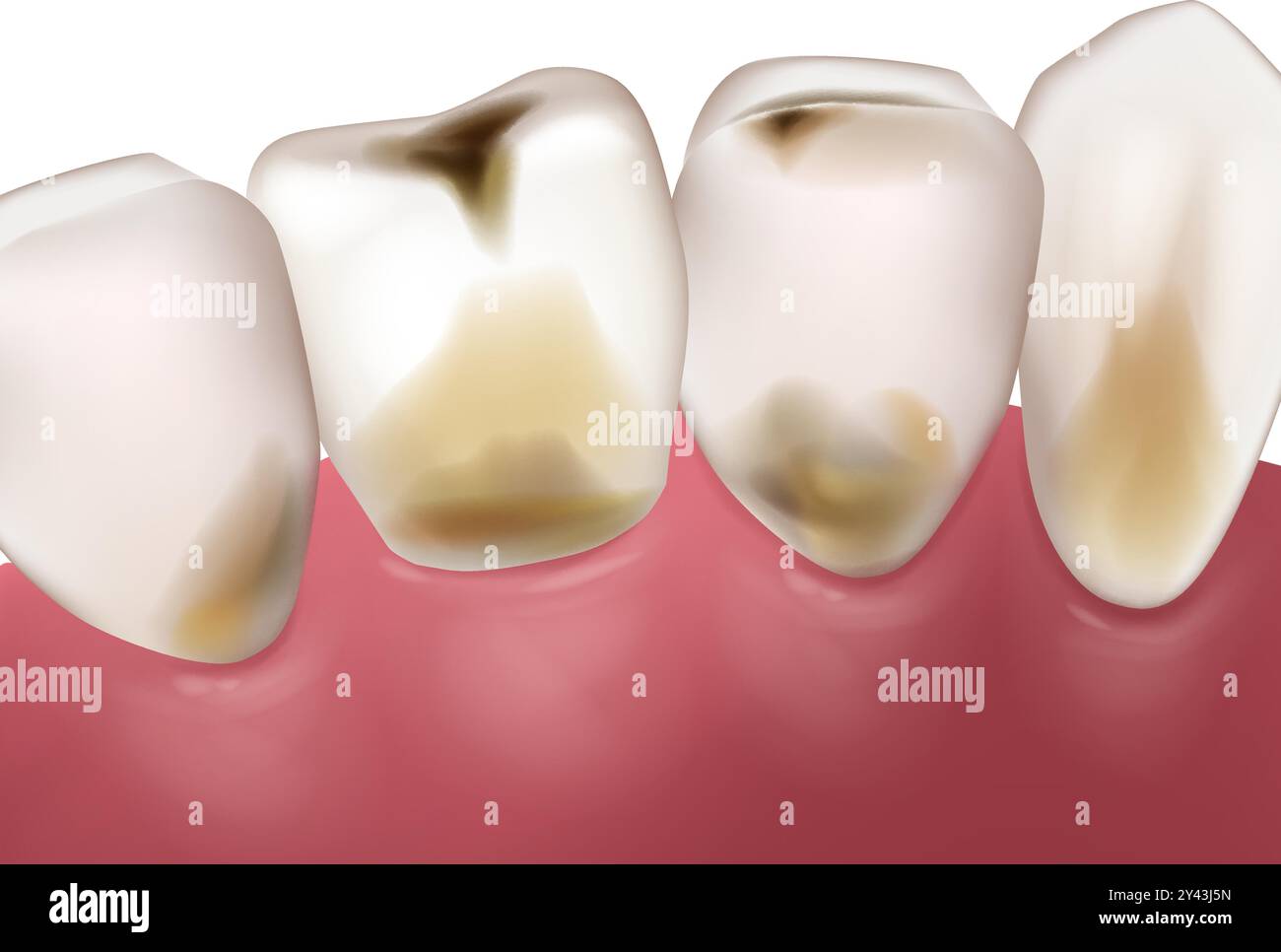 Dental cavities, dental caries, cavities, caries. Destruction of a ...