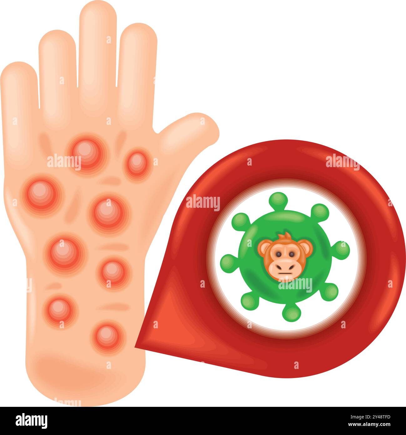 human hand with monkeypox skin infection Stock Vector Image & Art - Alamy