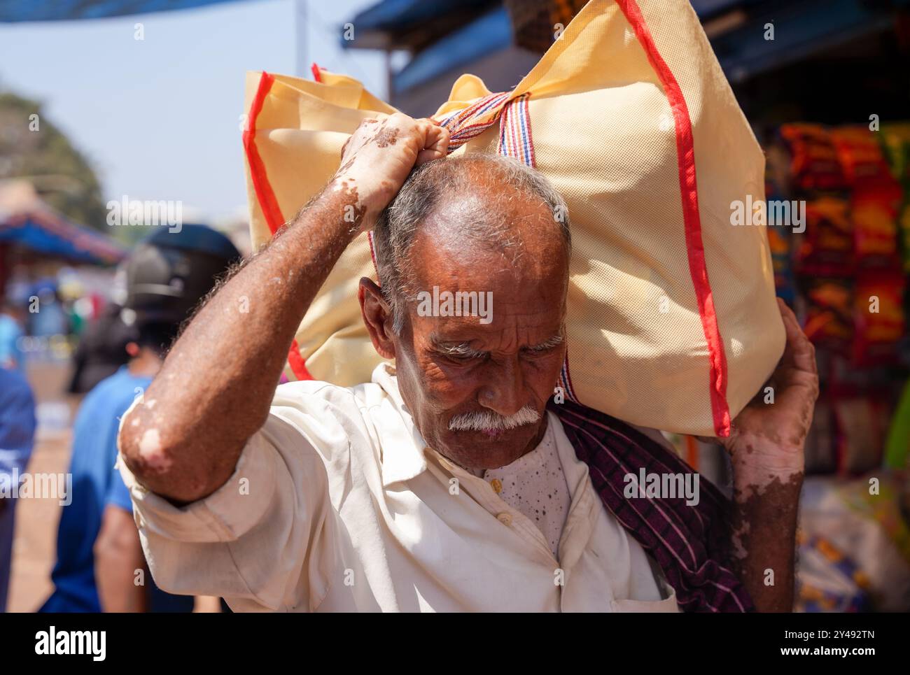 Mapusa, India - February 19, 2024: An adult man with depigmented spots ...