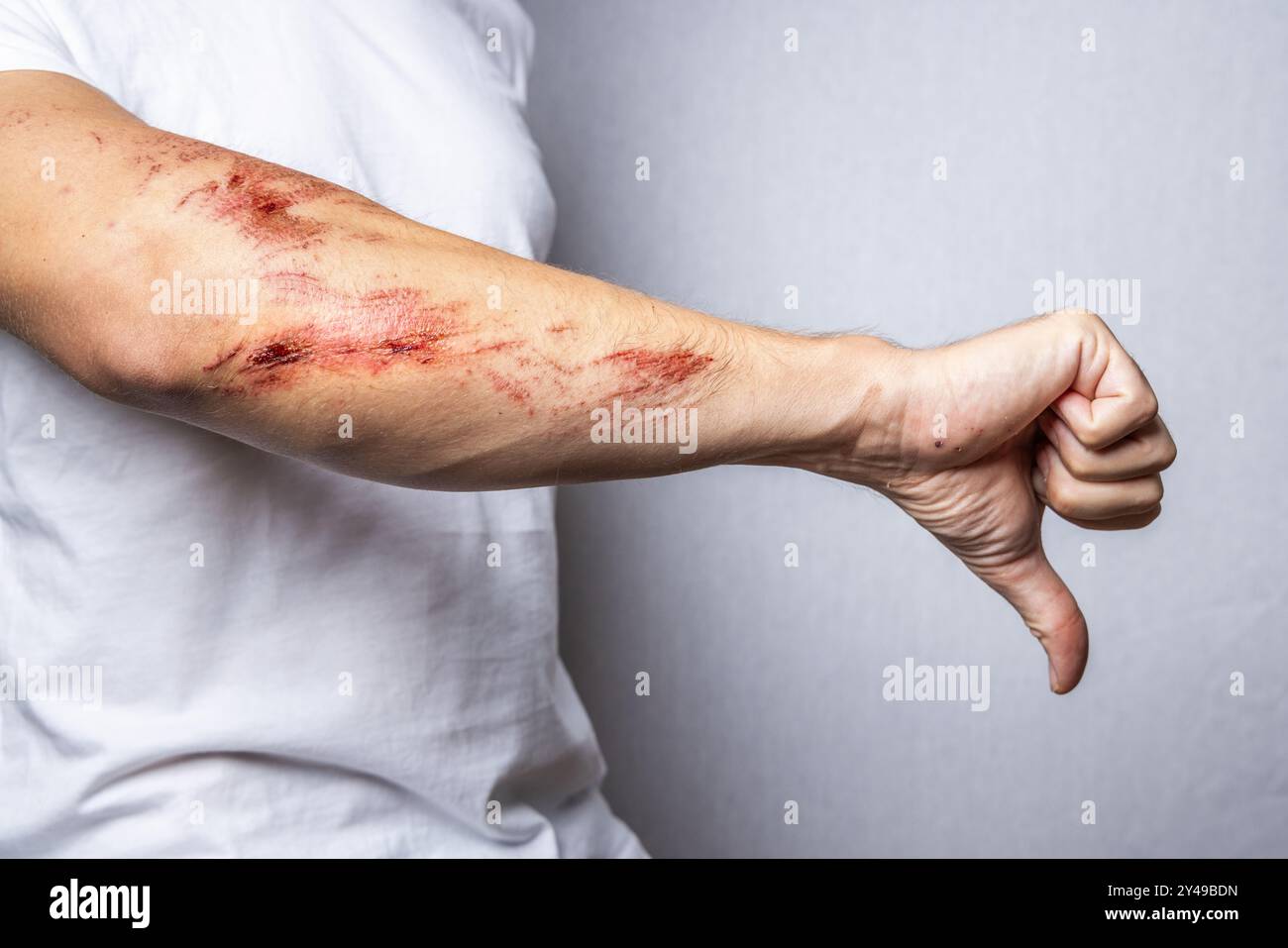Injured Arm with Scratches and Thumbs Down Gesture Stock Photo - Alamy