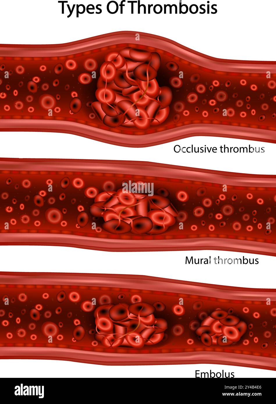 Embolus, Occlusive thrombus, Mural thrombus. Types Of Thrombosis Stock ...