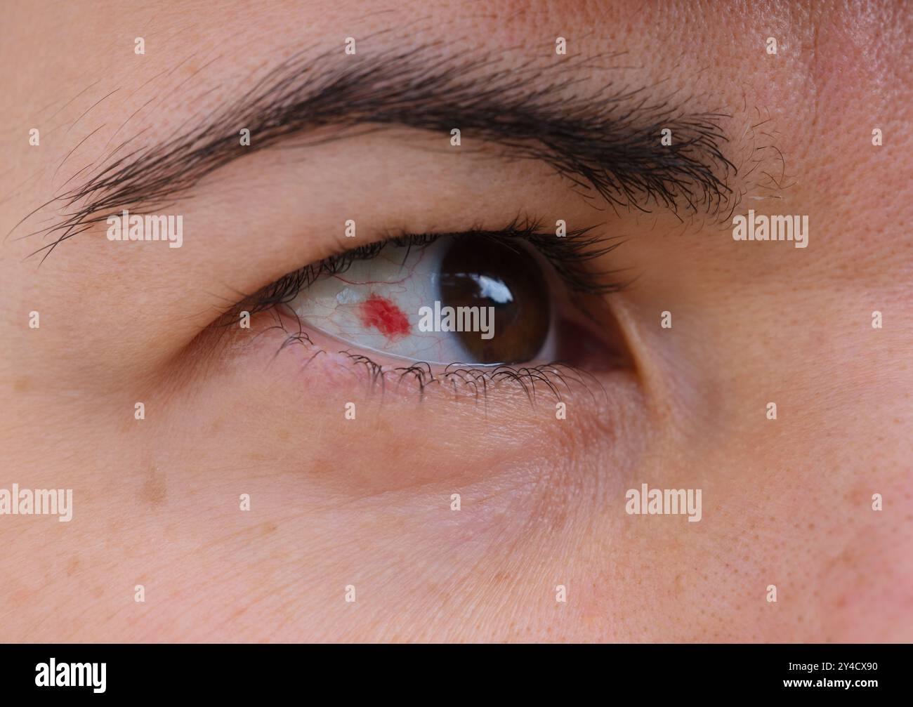 Subconjunctival hemorrhage hi-res stock photography and images - Alamy