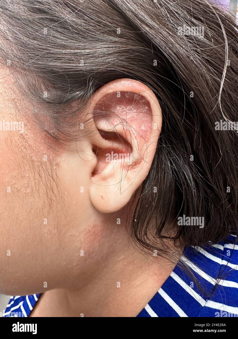Pinna Cellulitis This Is An Inflammation Of The Outer Ear Pinna Cartilage Arising From