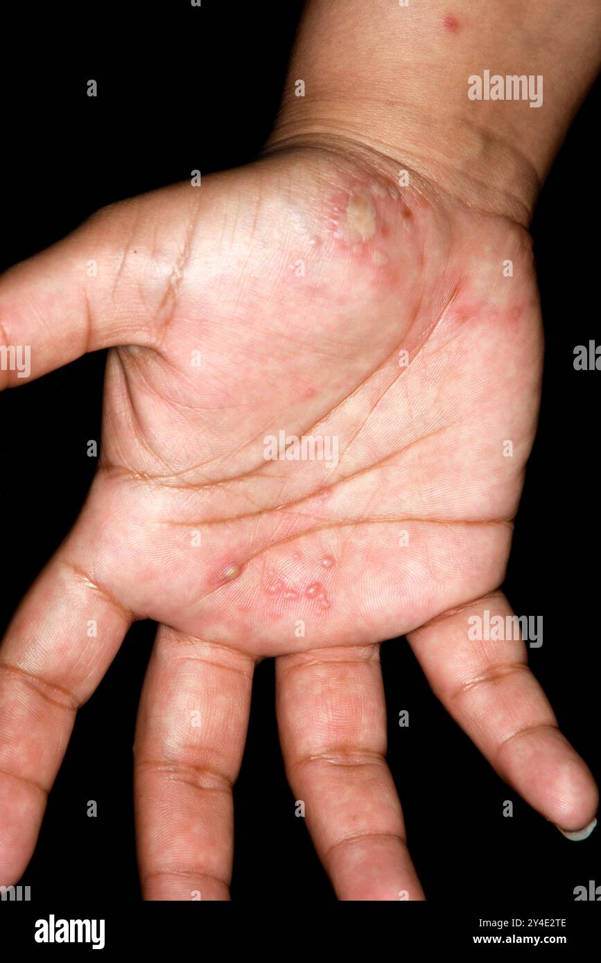 Pustular palmoplantar psoriasis on a 45 year old Hispanic female ...