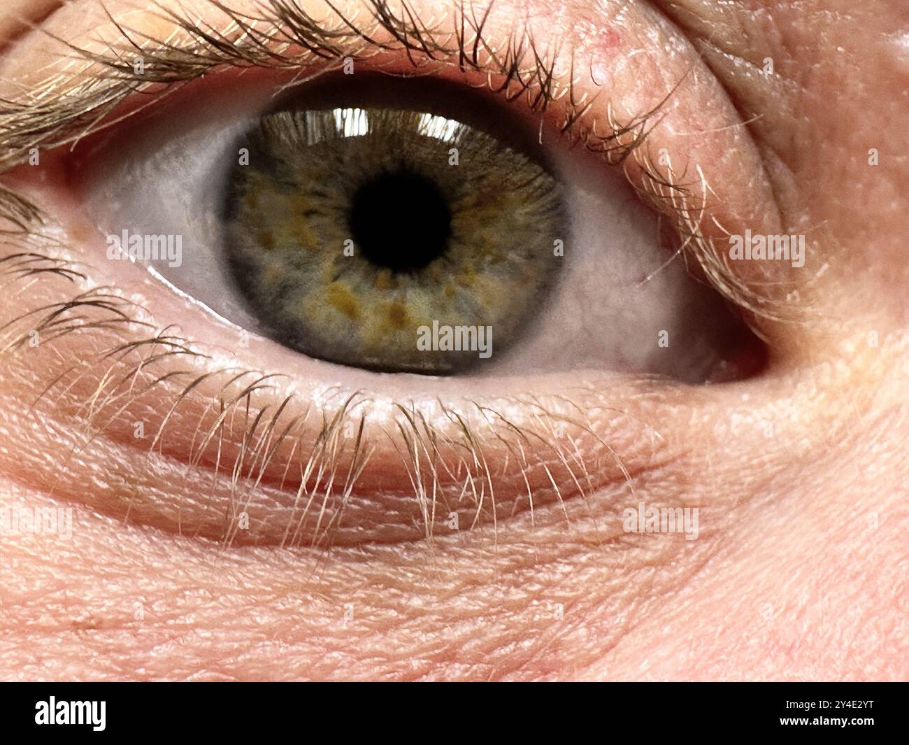 Recklinghausen's disease. Lisch nodules (brown spots) in the irises of ...