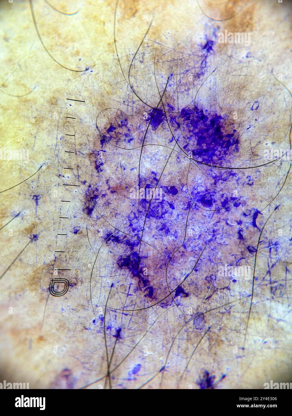 Cornoid lamella ink test for porokeratosis, dermoscopy Stock Photo - Alamy