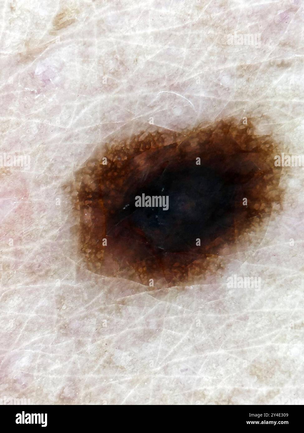 Dermatoscope image of a naevus, or mole, on a patient's skin. This skin ...