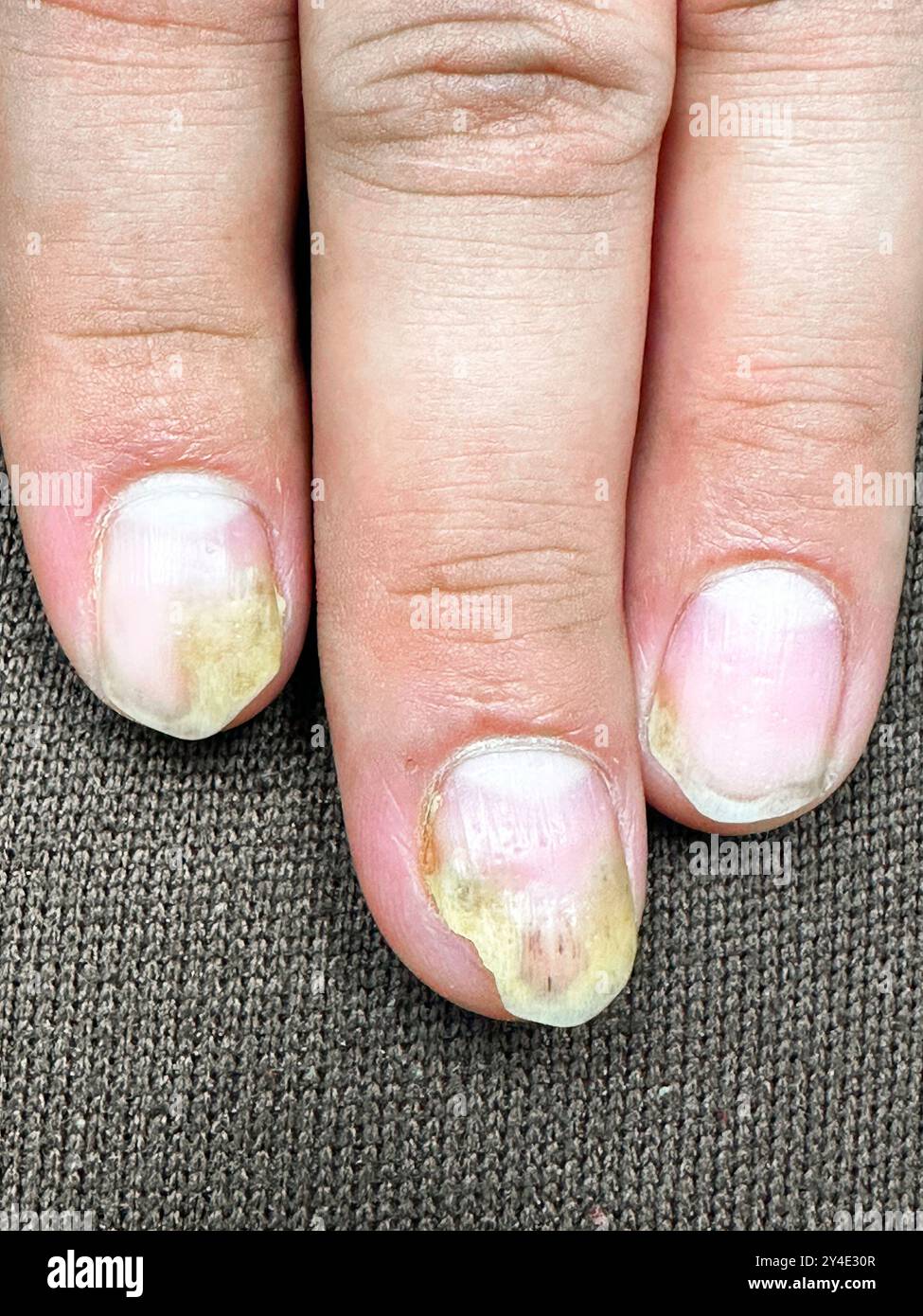Psoriasis and splinter haemorrhages on a patient's fingernails ...