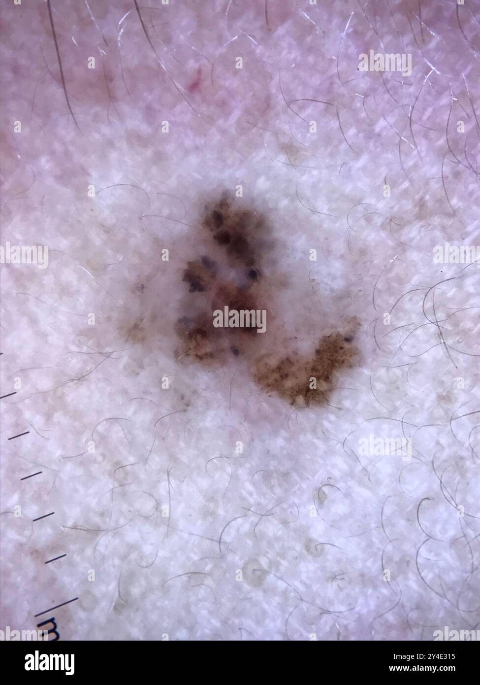 Dermatoscope image of a nodular basal cell carcinoma (BCC), or rodent ...