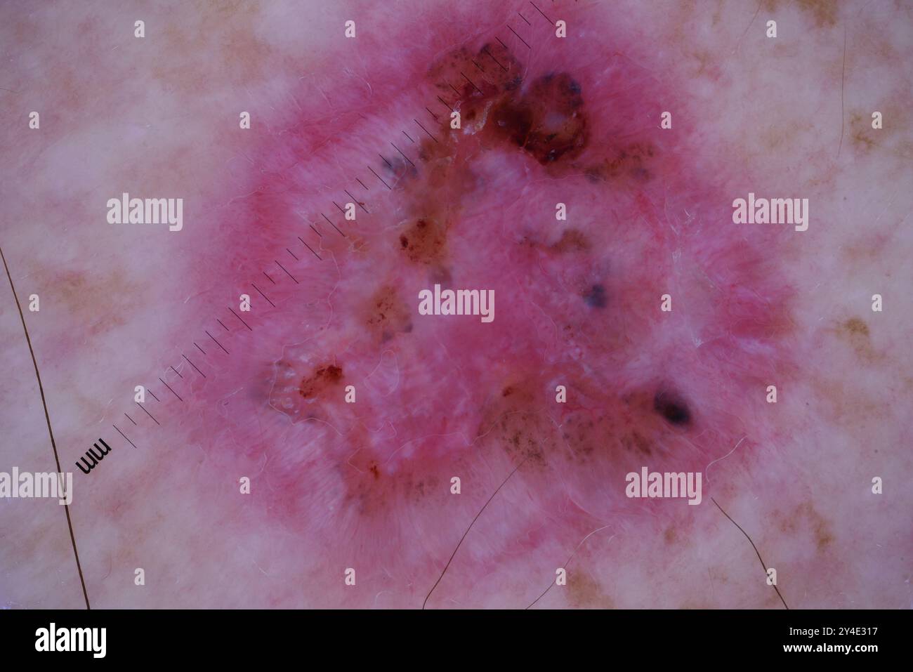Dermatoscope image of a basal cell carcinoma (BCC), or rodent ulcer, on ...