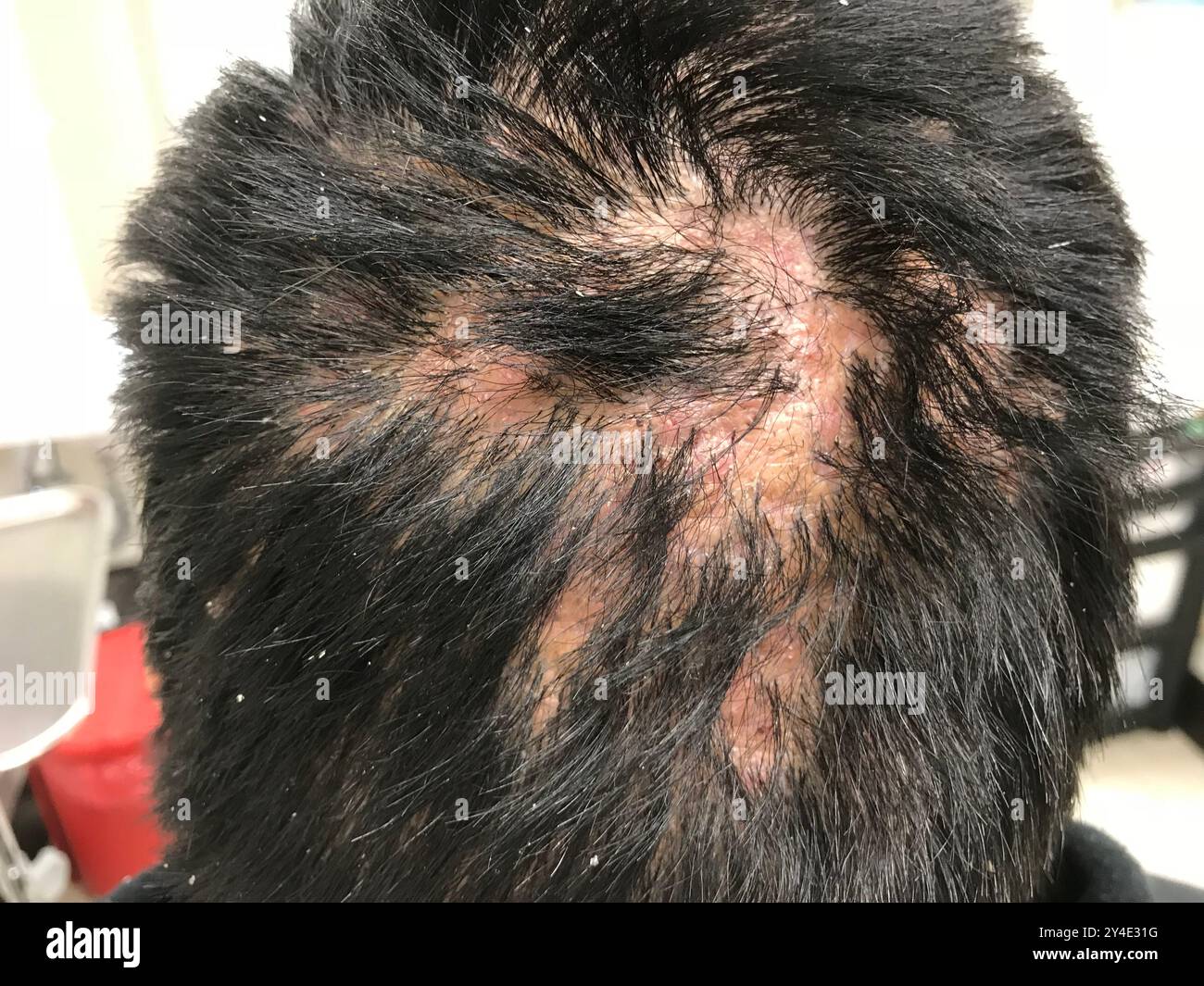Dissecting cellulitis. This scalp condition is a chronic suppurative ...