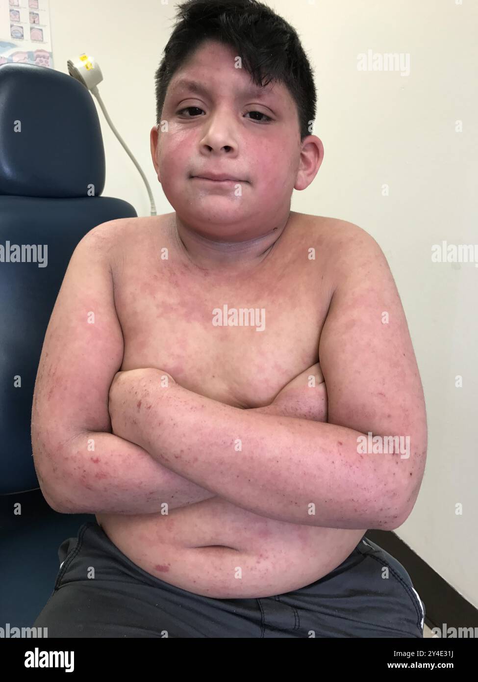 Boy with severe atopic dermatitis who has been treated with the ...