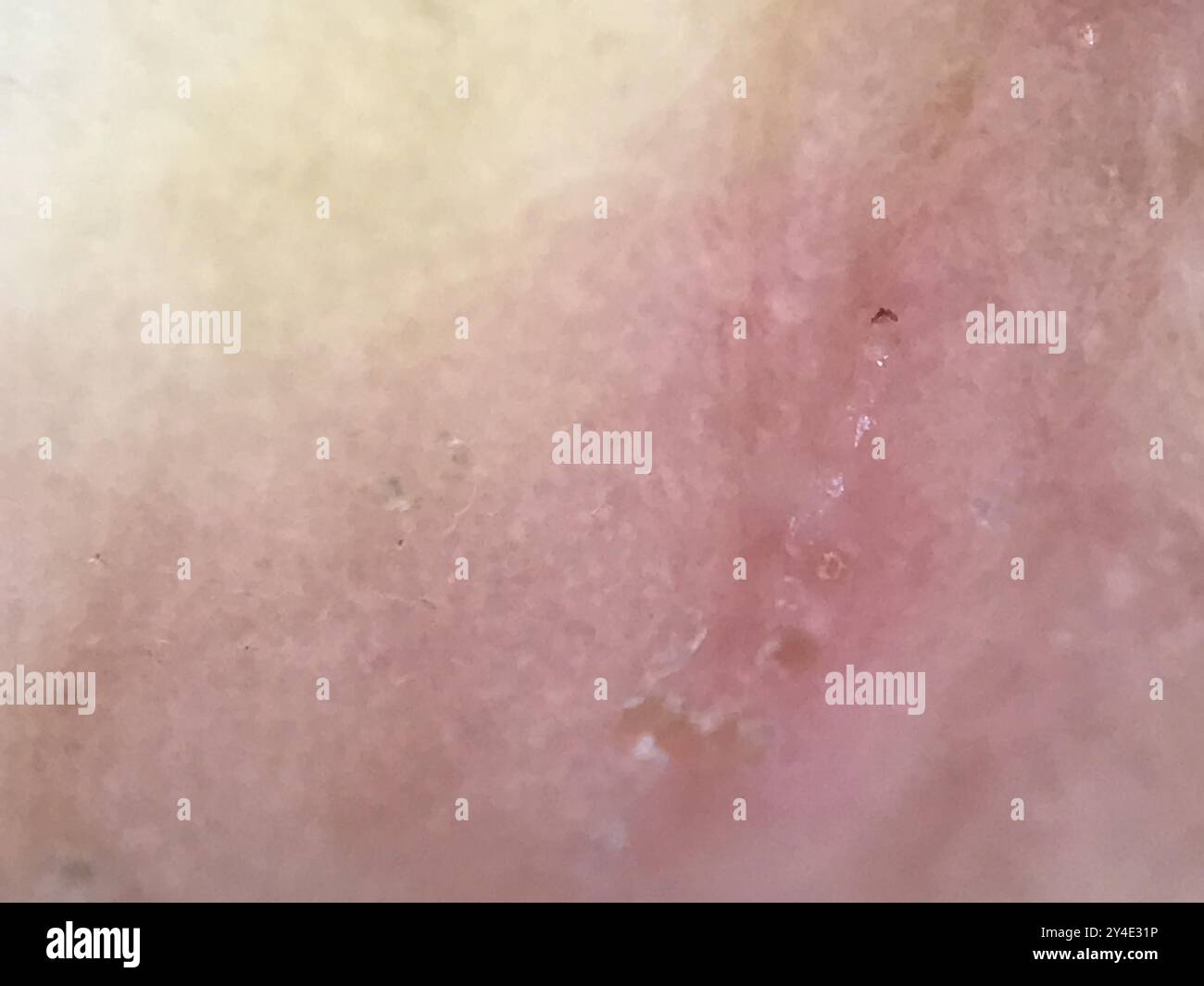 Dermatoscope image of the skin of a patient who has been treated with ...