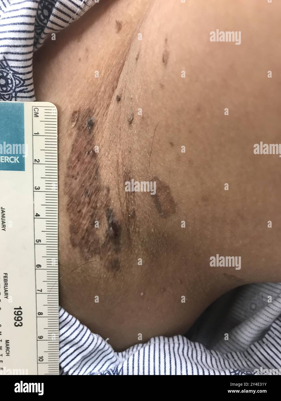 Basal cell carcinoma (BCC), or rodent ulcer, in a patient's armpit ...