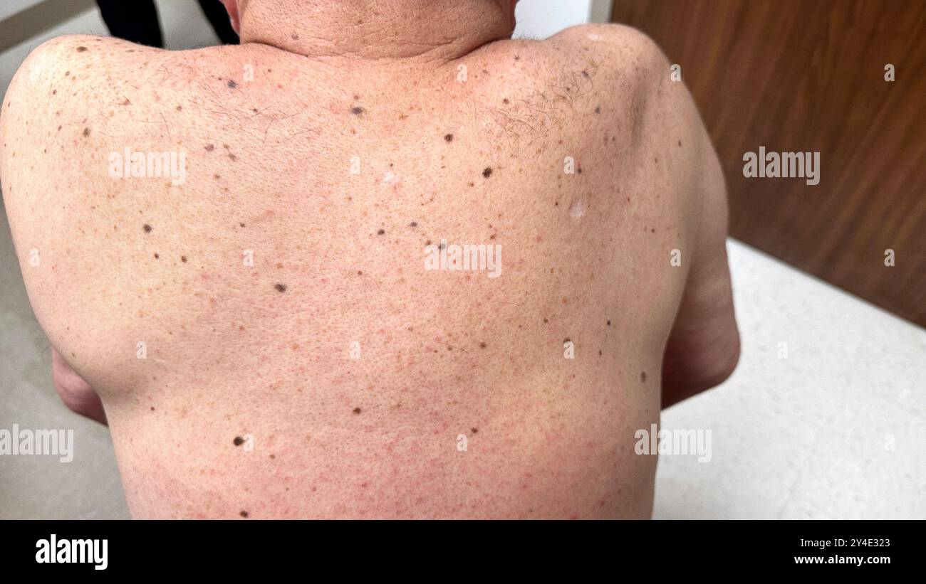Moles on a male patient's back. These skin marks are caused by a ...