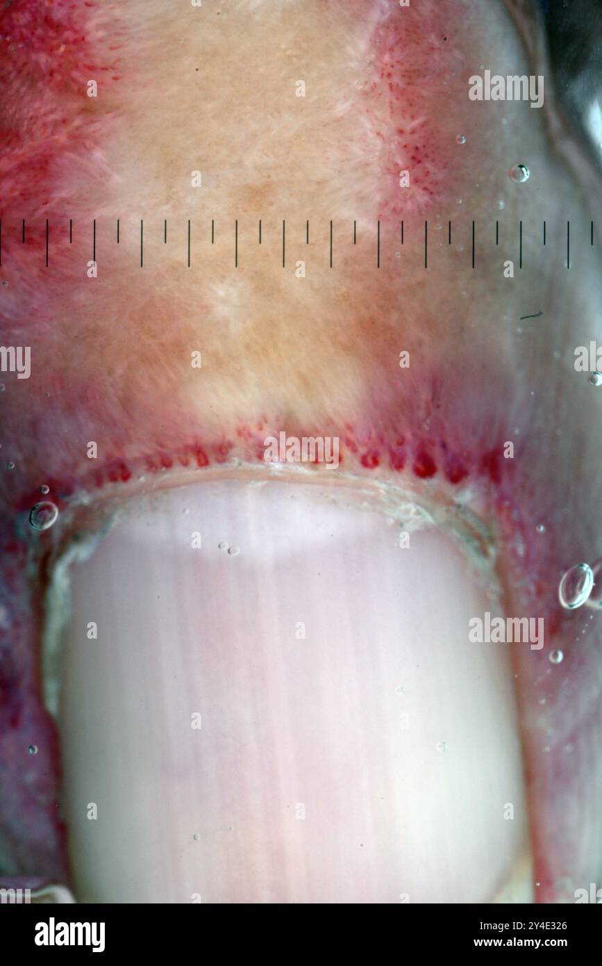 Dermatoscope image of dermatomyositis of the cuticles. Dermatomyositis ...
