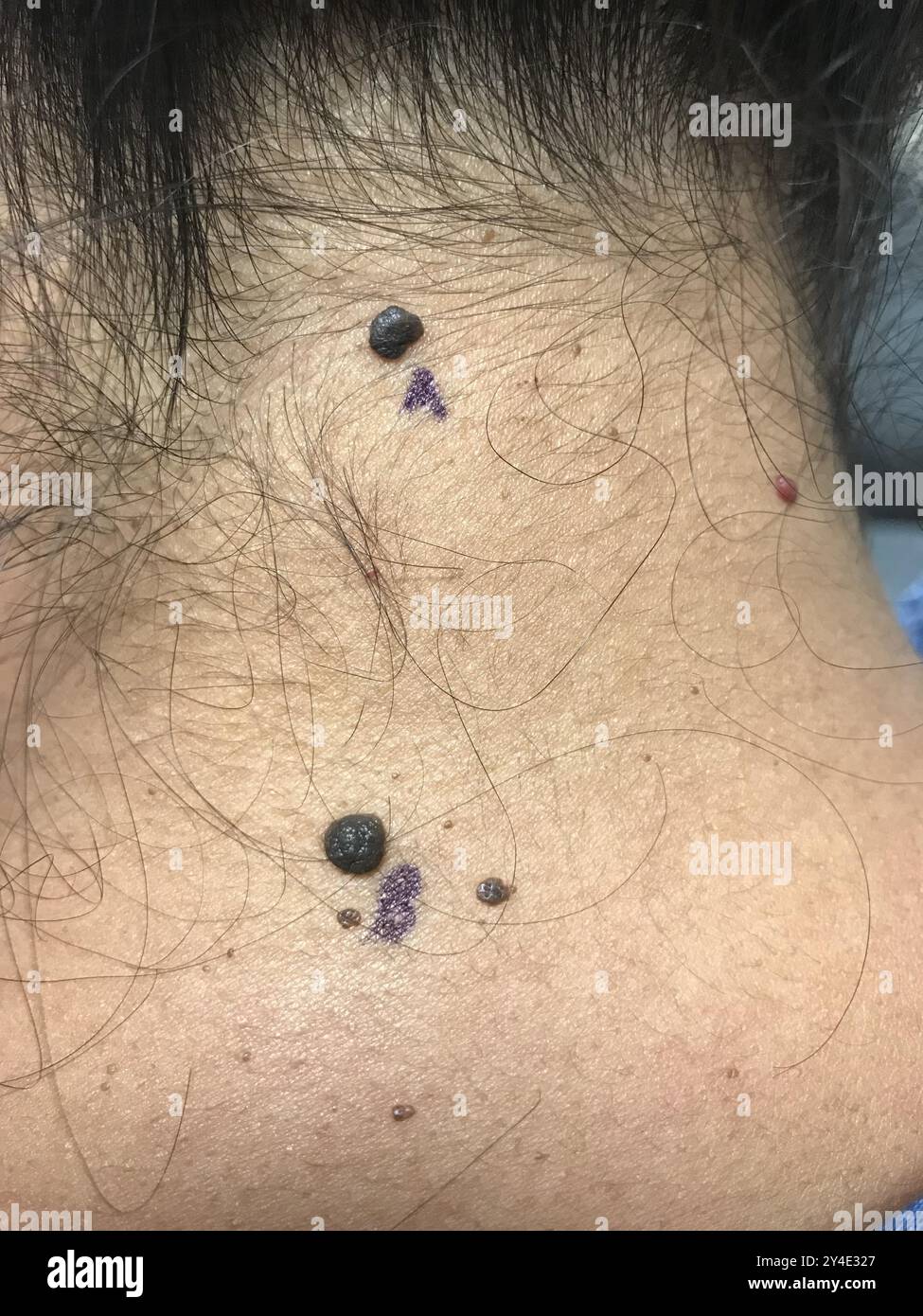 Moles on a patient's neck. These skin marks are caused by a ...