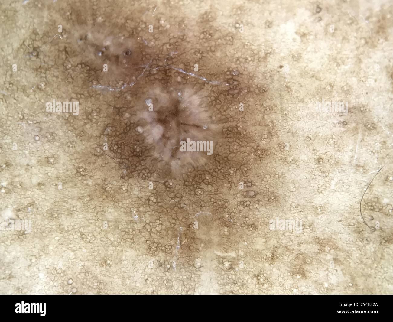 Dermatoscope image of a dermatofibroma on a female African-American ...