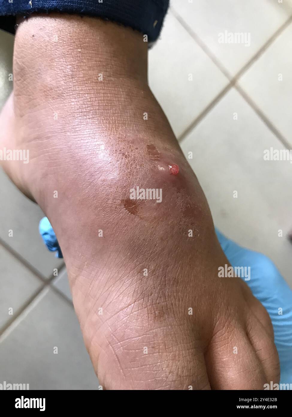 Abscess on a patient's foot. An abscess is a painful pus-filled ...