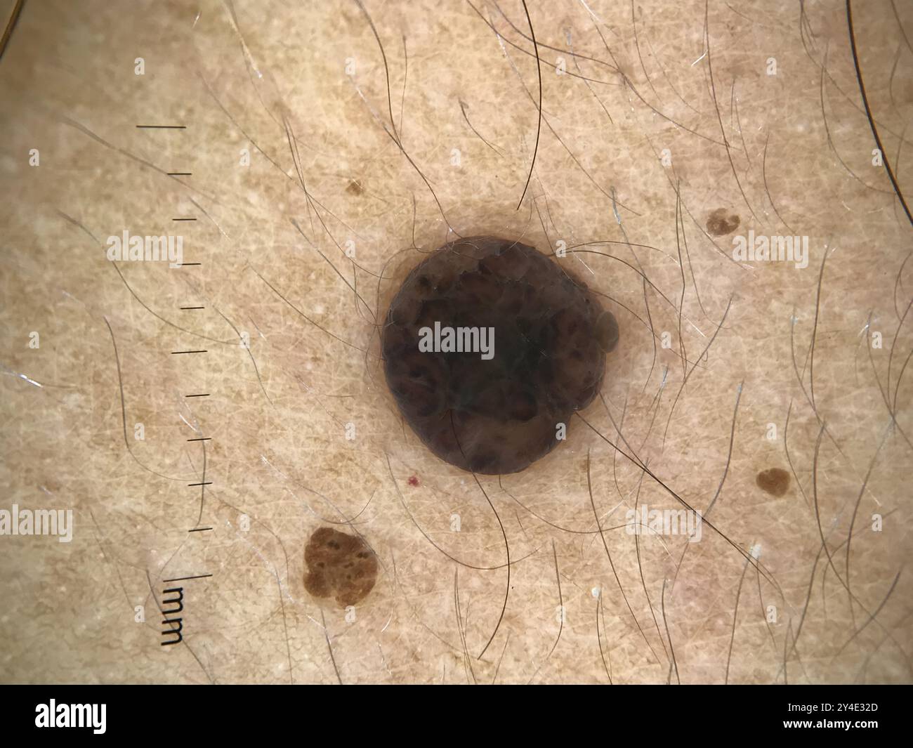 Dermatoscope image of a mole. This skin mark is caused by a ...